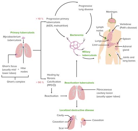 Pathogenesis Of Tuberculosis Tb Pathogenesis Can Be D