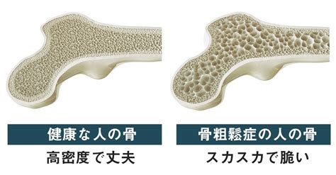 骨粗鬆症 部位・症例解説 森整形外科｜愛知県一宮市の整形外科・リハビリ｜ネット予約対応