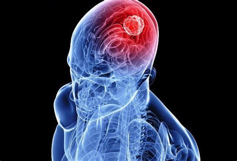 Ictus Infarto Y Derrame Cerebral Instituto Europeo De Salud Y