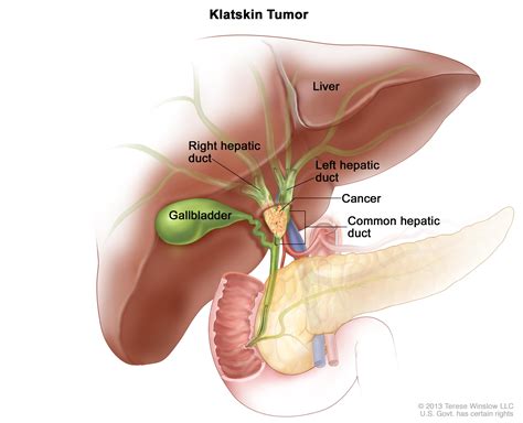 Bile Duct Cancer Treatment Pdq® —health Professional Version