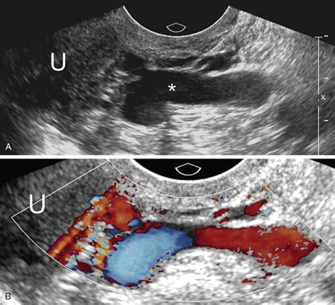 Ultrasound Evaluation Of The Fallopian Tube Obgyn Key