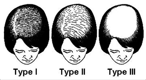 Ludwig Scale Causes Stages And Treatment Wimpole Clinic