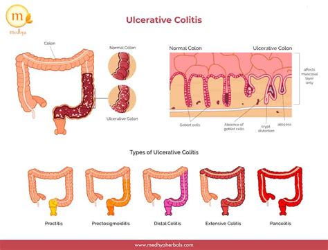 Ulcerative Colitis Causes Symptoms And Support Strate