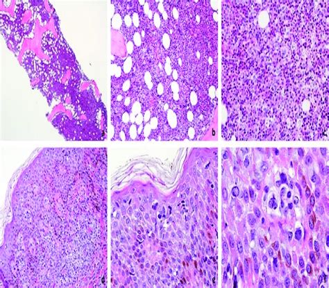 Bone Marrow Involvement In Atll A An Interstitial Spread Pattern Is