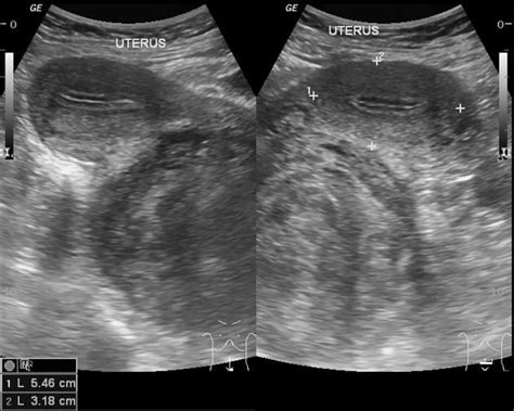 Wk 3 L 2 Sub Serosal Leiomyoma Of The Uterus Radiology Reference