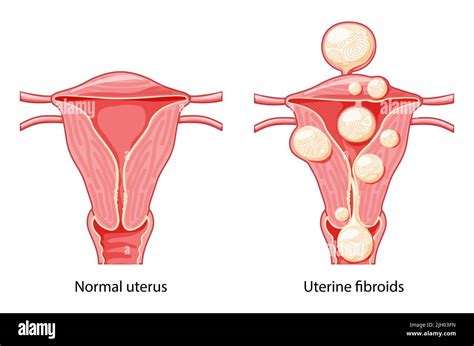 Set Of Uterine Fibroids Female Leiomyomas Reproductive System Uterus