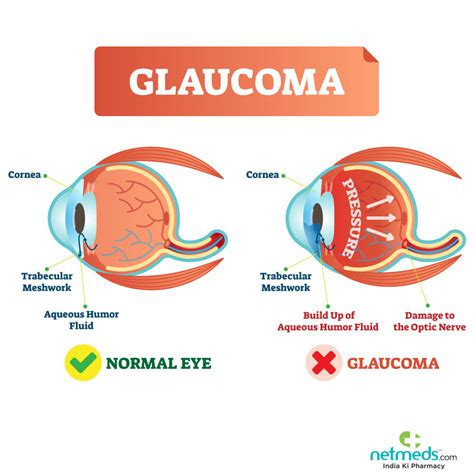 Acute Angle Glaucoma Symptoms