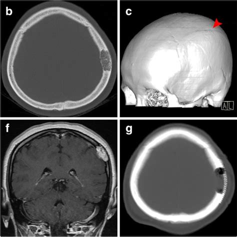 Axial Ct Scans A B Soft Tissue Window And Bone Window And A