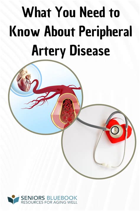 What You Need To Know About Peripheral Artery Disease Sbb
