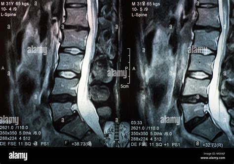 Imagen De Resonancia Magnética De La Columna Vertebral Con La Lordosis