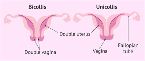 Types Of Uterine Didelphys