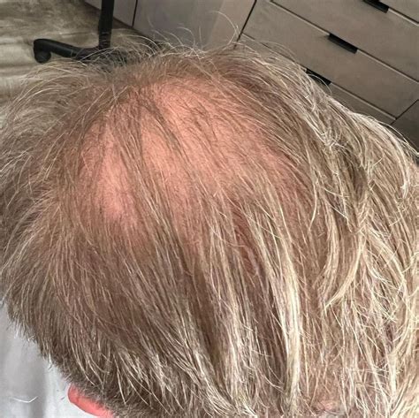 Hairskeen Hair Replacement For Men Columbus Oh Pleij Salon Spa