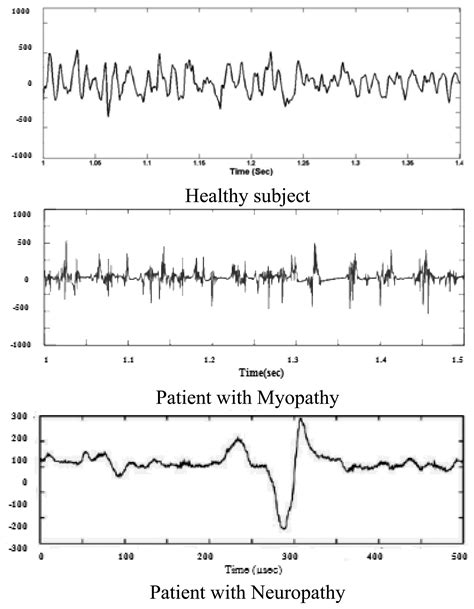 Sensors Free Full Text Surface Electromyography Signal Processing