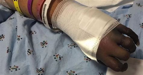 Womans Four Limbs Amputated After Allergic Reaction Put Her Into