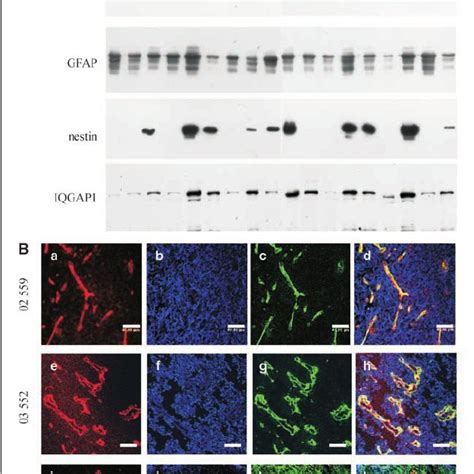 Iqgap1 Expression Specifies Tumor Amplifying Cells In Human