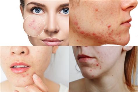Những điều Có Thể Bạn Chưa Biết Về Mụn Nội Tiết