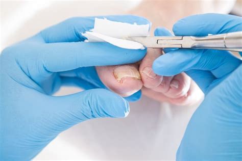 How To Get Rid Of Toenail Fungus With Bleach Chronichives