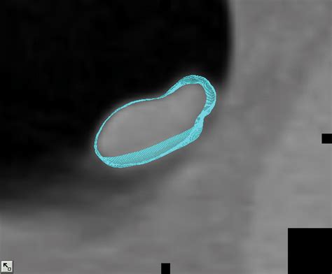 Polyp Volume Versus Linear Size Measurements At Ct Colonography