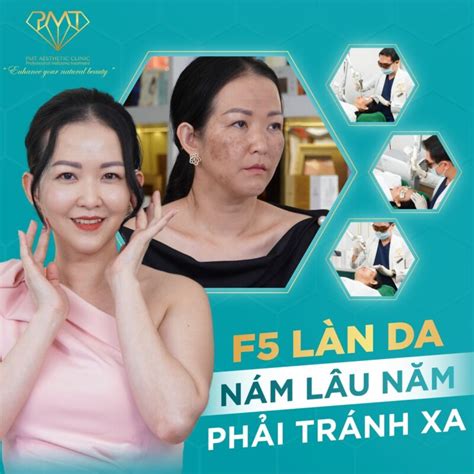 Nám Kháng Trị Cách Nhận Biết Và Các Phương Pháp điều Trị Hiệu Quả
