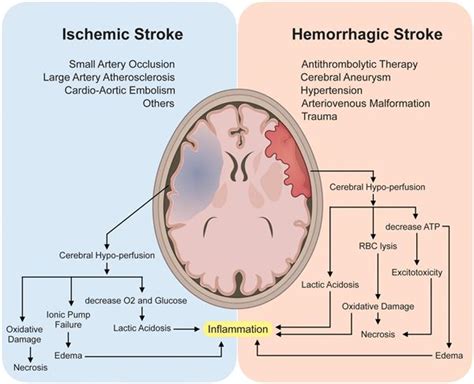 Different Types Of Ischemic Strokes