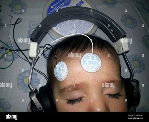 Brainstem Evoked Response Audiometry Also Auditory Brainstem Response