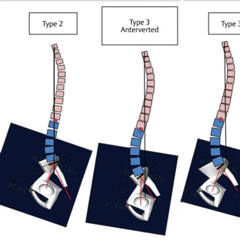 The Different Types Of The Roussouly Classification Download