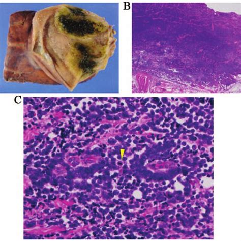 Pathological Analysis A Macroscopic Features Of The Resected