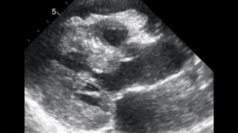Cardiac Amyloidosis Echocardiography Case1 Dr Alexandru Mischie