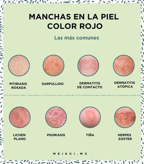 Manchas En La Piel Causas Tipos Y Tratamientos