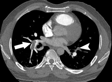 The Rsna Pulmonary Embolism Ct Dataset Radiology Artificial Intelligence