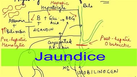 Hemolytic Hepatic And Obstructive Jaundice Icterus Gastrointestinal