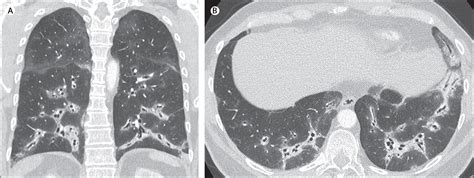E Cigarette Induced Lung Disease From Acute To Chronic The Lancet