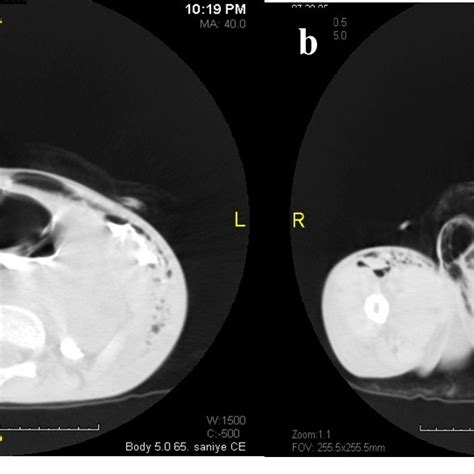 Abdominal Computerized Tomography Scan Demonstrated Subcutaneous