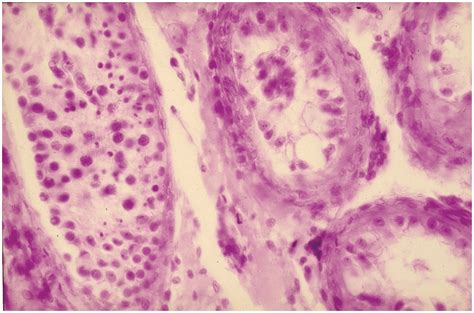 Chapter 3 Testicular Histopathology And The Role Of Testis Biopsy