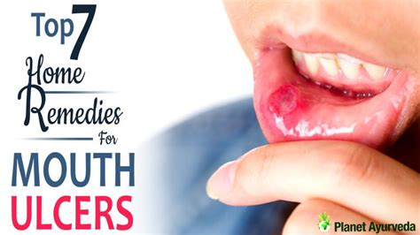 Top 7 Home Remedies For Mouth Ulcers