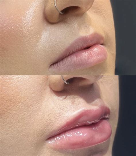Maryland Lip Enhancement Henry F Garazo Md Facs