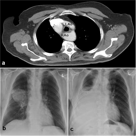 A Axial Computed Tomography Scan Showing Daa With A Dominant Right