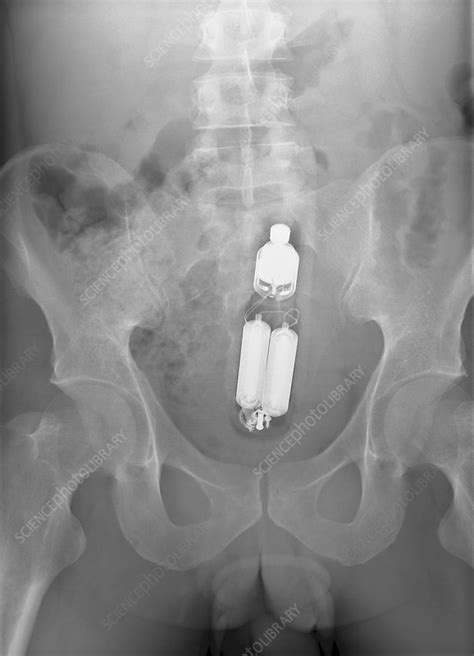 sex toy in man s rectum x ray stock image m315 0033
