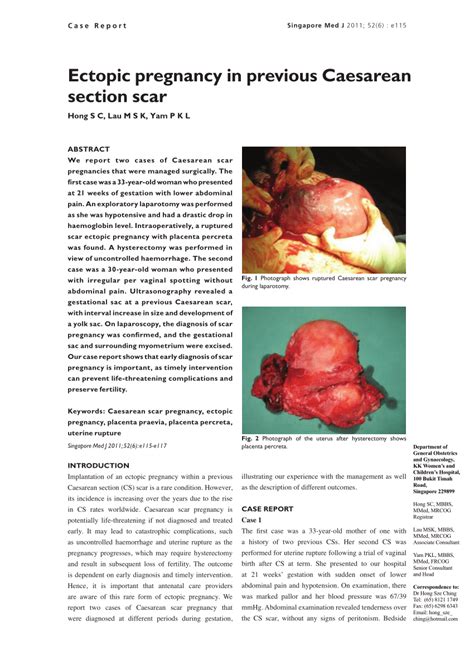 Cesarean Scar Pregnancy