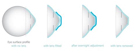 Myopia Control Mission Eye Care