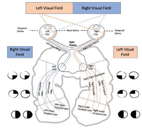 Inferior Temporal Visual Field Defect