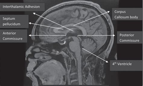 Full Article Mri Based Morphometric Analysis Of Corpus Callosum