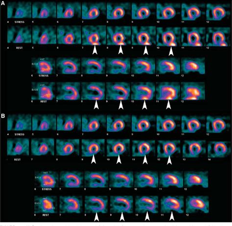 Figure 1 From Artifacts And Pitfalls In Myocardial Perfusion Imaging