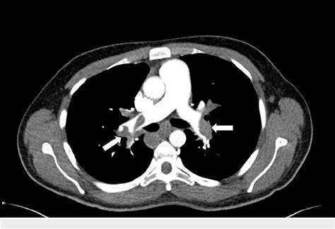 Figure 1 From A Rare Case Of Pulmonary Embolism In A Patient With