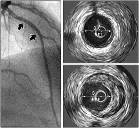 Intravascular Ultrasound Circulation