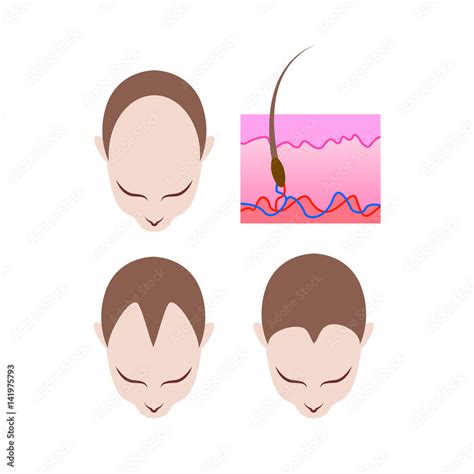 Male Hair Loss Stages Set Man Before And After Hair Treatment And Hair