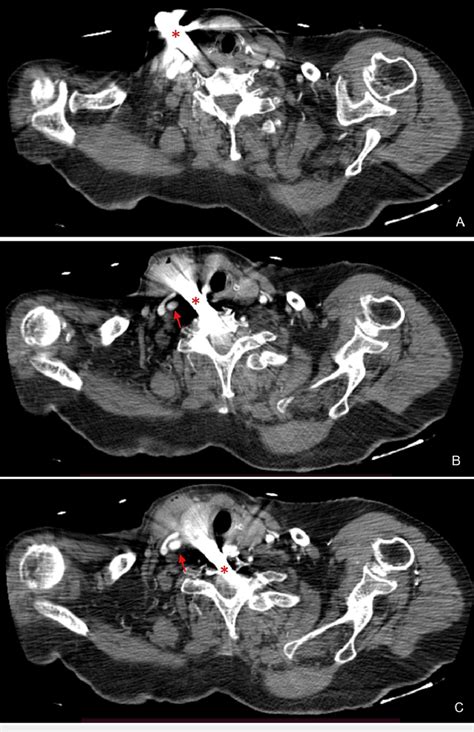 Axial Enhanced Computed Tomography Ct Acquisitions Showing A