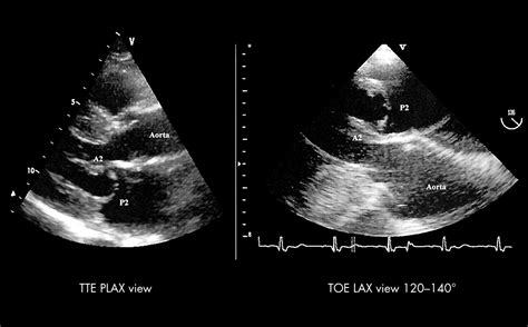 Degenerative Mitral Valve Disease With Emphasis On Mitral Valve