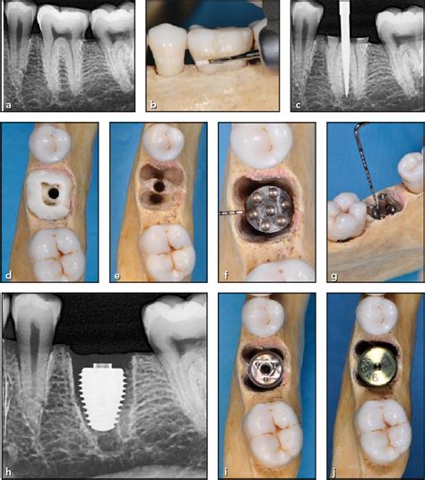 [pdf] Immediate Placement Of Ultrawide Diameter Implants In Molar