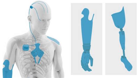 Bionic Arm Restores Sense Of Feeling Bbc News